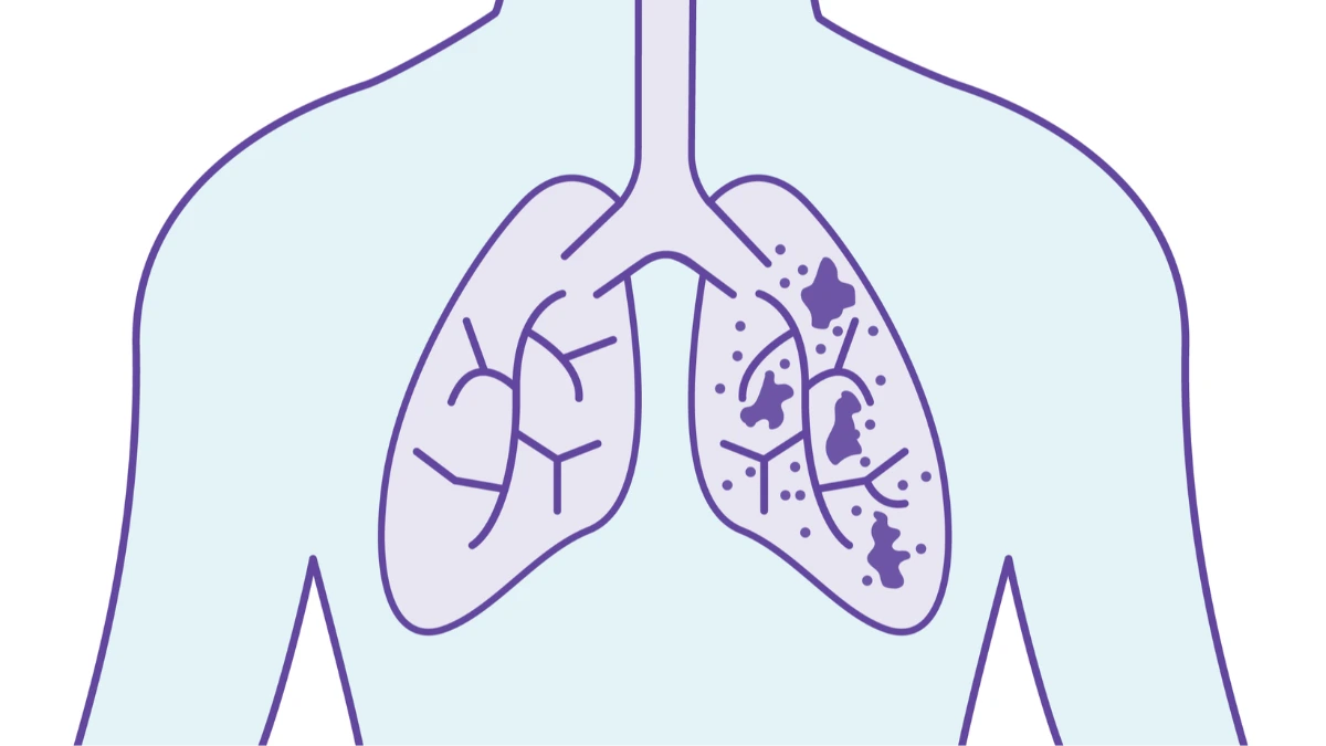 COPD | Tags | ndd Medical Technologies
